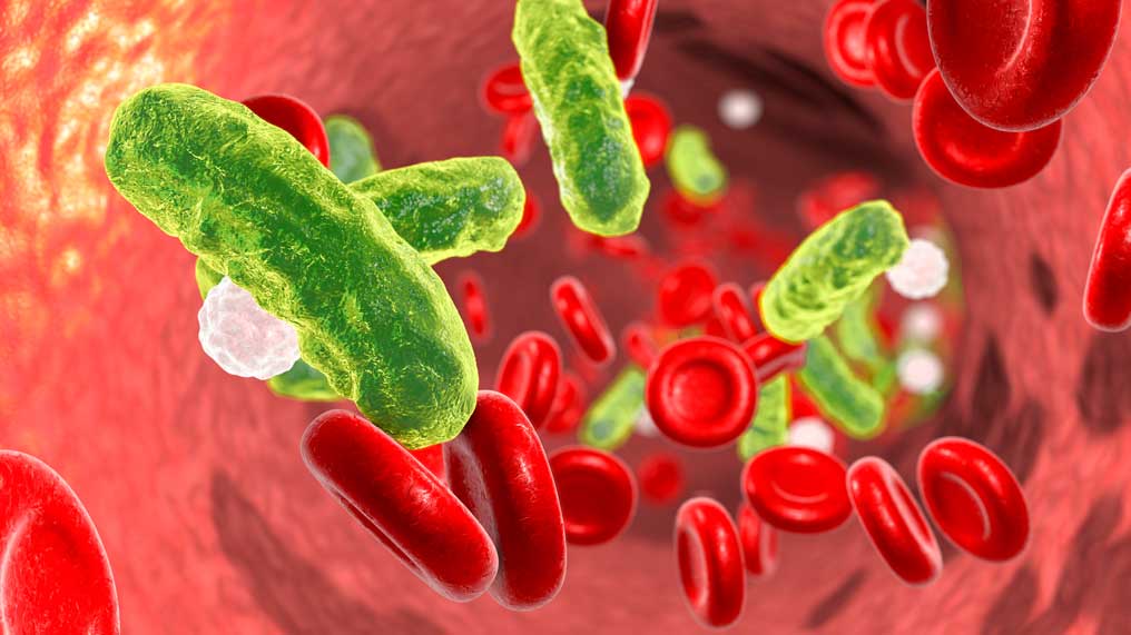 Sepsis: What Is It And How Can You Spot It?
